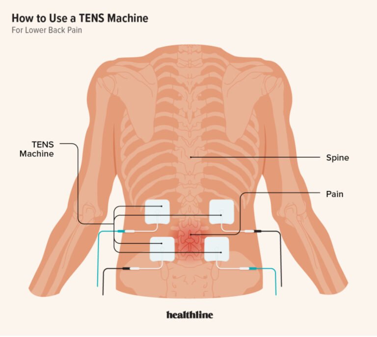 TENS for back pain – Transcutaneous electrical stimulation of nerves TENS