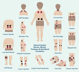 What is TENS – Transcutaneous electrical stimulation of nerves TENS